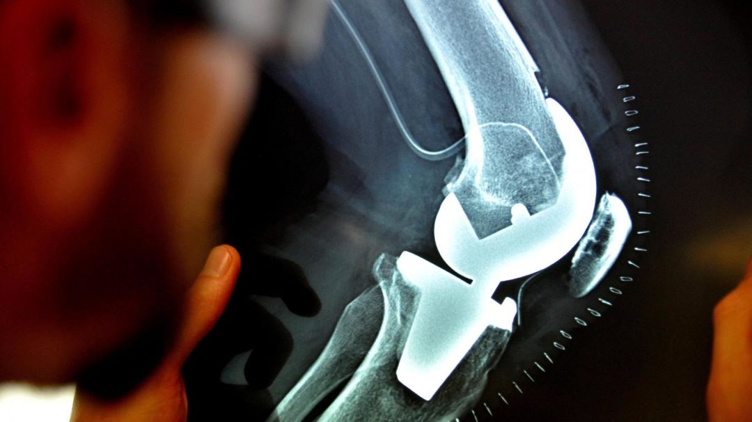 Prothése orthopédique | Highness Medical